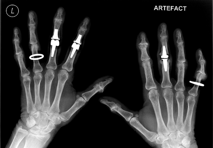 Reumatoid Arthritis & Osteoarthritis | Hand Injuries | The Hand Specialist